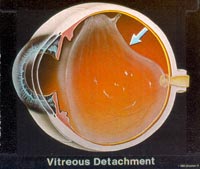 T-Z - Uveitis.org | OIUF